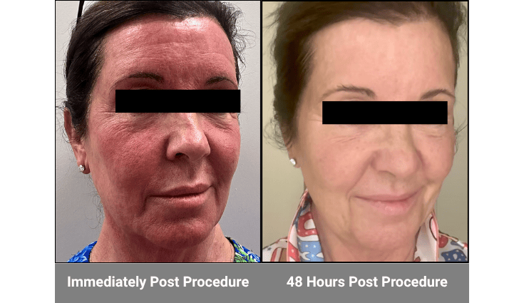 5+ Defensin Recovery Serum | Post-Procedure Support for Skin Renewal